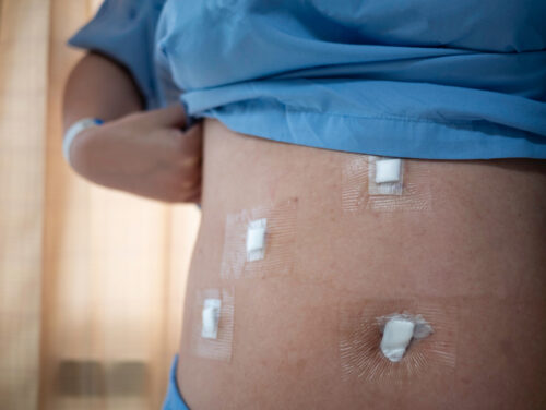 Post-Operative Wound Healing: Top 10 Best Practices Post-Operative Wound Healing: Top 10 Best Practices